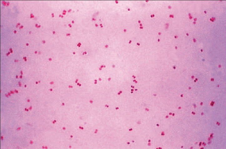 Gonococcal Conjunctivitis | Consultant360